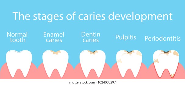 Stomatological Concept Stages Caries Development Development Stock ...