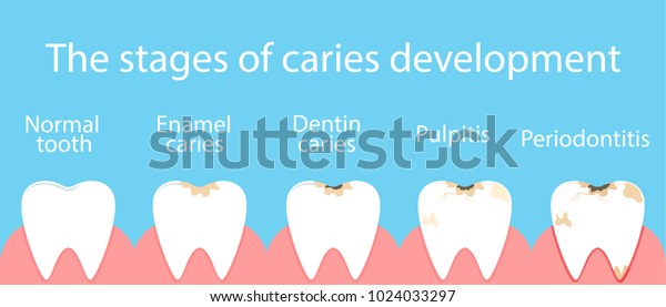 Stomatological concept. Stages of caries development. Development of ...