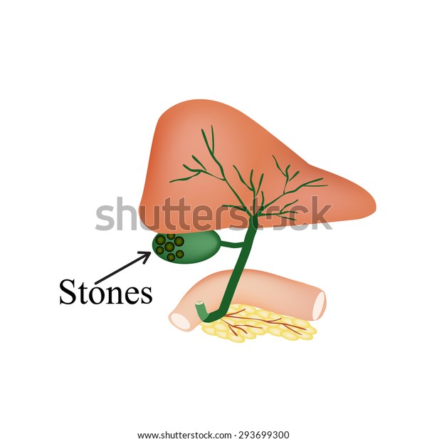 The stones in the gallbladder. Duodenum, pancreas, bile ducts. Vector ...