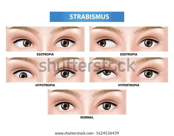 Strabismus Crossed Eye Vector Illustration 库存矢量图（免版税）1624536439