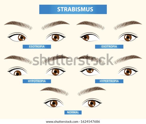 Strabismus Crossed Eye Vector Illustration Stock Vector (Royalty Free ...