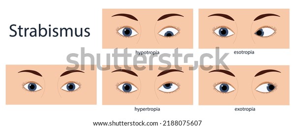 Strabismus Flat Style Infographic Set Stages: เวกเตอร์สต็อก (ปลอดค่า ...