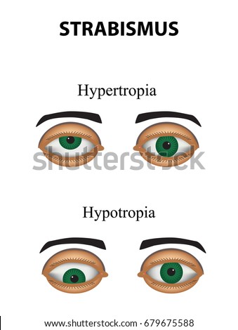 Strabismus Hypertropia Hypotropia Infographics Vector Illustration 库存矢量 ...