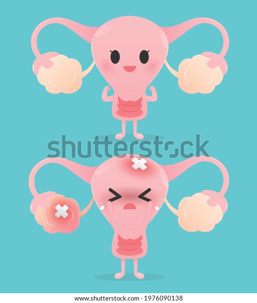 Strength Uterus Uterine Problems Miometrium Cartoon Stock Vector ...