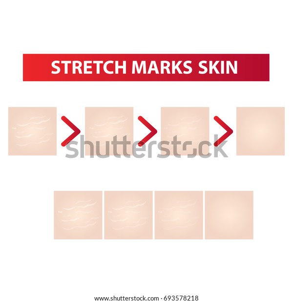 Stretch Marks Skin Clear Steps Vector Stock Vector (Royalty Free ...