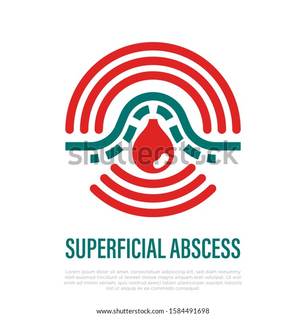 Superficial Abscess Thin Line Icon Pus: Vector có sẵn (miễn phí bản ...