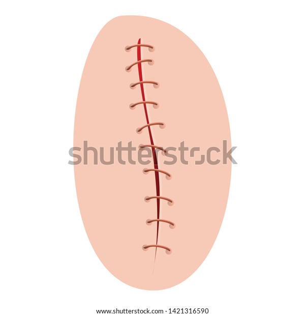 Surgical Suture Icon Cartoon Surgical Suture Stock Vector (Royalty Free ...