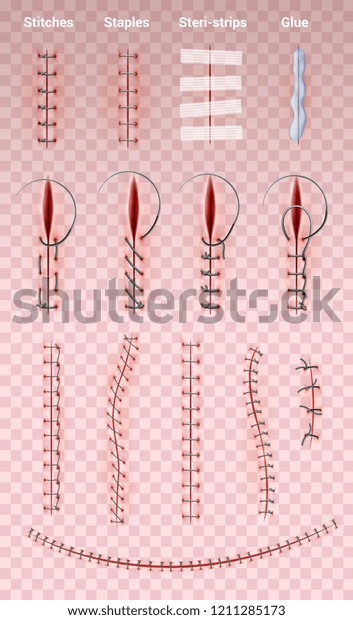 Surgical suture stitches realistic set of images on transparent ...