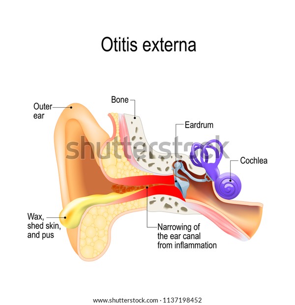 Swimmers Ear Otitis Externa Inflammation Ear Stock Vector (Royalty Free ... Swimmers Ear Otitis Externa Inflammation Ear Stock Vector (Royalty Free ...