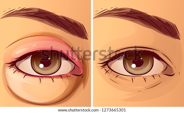 Swollen Eye Beforeafter Vector Illustration: เวกเตอร์สต็อก (ปลอดค่า ...
