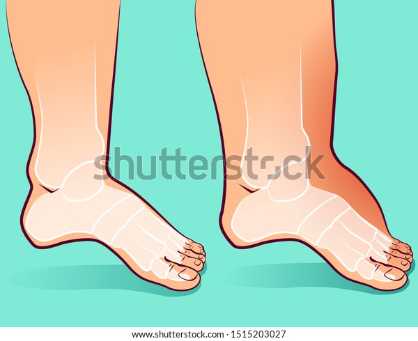 Vektor Stok Swollen Feet Beforeafter Vector Illustration (Tanpa Royalti ...