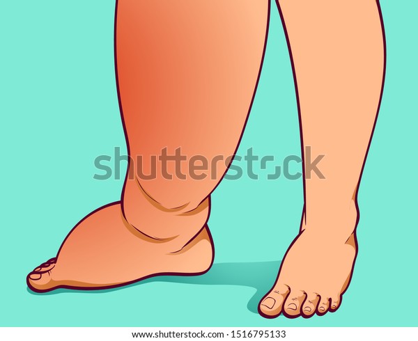 Swollen feet, before-after. Vector illustration