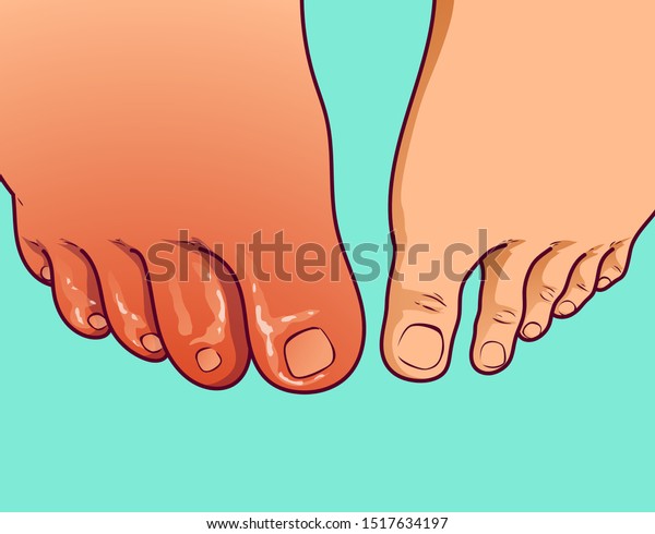 Swollen Feet Beforeafter Vector Illustration: เวกเตอร์สต็อก (ปลอดค่า ...