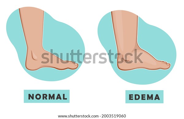 Swollen Foot Ankle Normal Foot Edema Stock Vector (Royalty Free ...