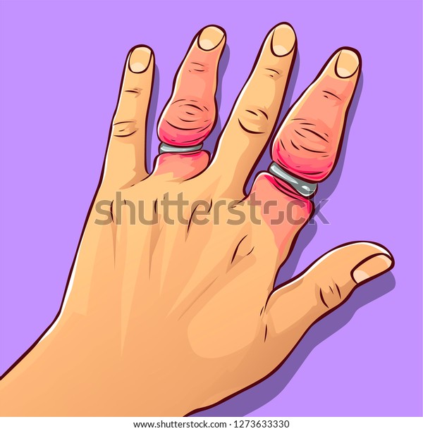 Swollen Hand Rings Vector Illustration Stock Vector (Royalty Free ...