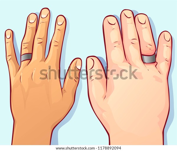 Swollen Hands Vector Illustration Stock Vector (Royalty Free) 1178892094