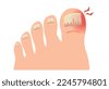 3+ Thousand Ingrown Toenail Royalty-Free Images, Stock Photos ...