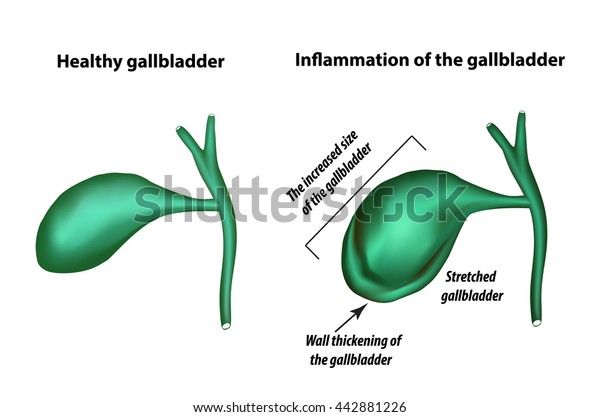 Symptoms Gallbladder Inflammation Cholecystitis Thickening Gallbladder ...