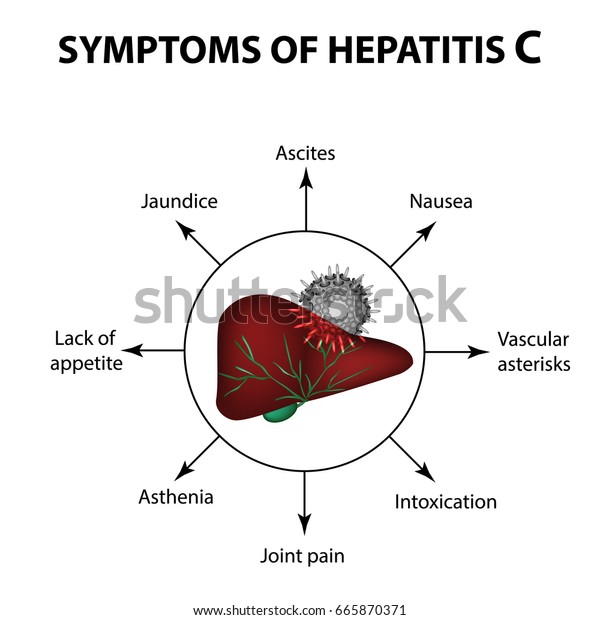 Symptoms Hepatitis C Liver World Hepatitis: เวกเตอร์สต็อก (ปลอดค่า ...