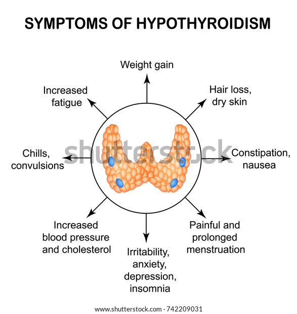 Symptoms Hypothyroidism Thyroid Infographics Vector Illustration Stock ...