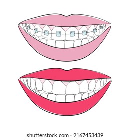 Teeth Braces One Line Drawing On Stock Vector (Royalty Free) 2167453439 ...