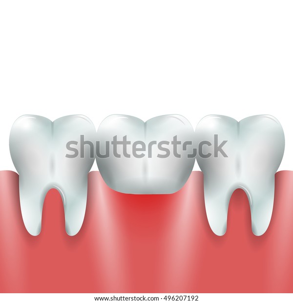 Teeth Family with Dental Bridge Crown in Healthy Gum.Dental Bridge ... Teeth Family with Dental Bridge Crown in Healthy Gum.Dental Bridge ...