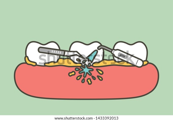 Teeth Scaling Dental Plaque Removal Cleaning Stock Vector (Royalty Free ...