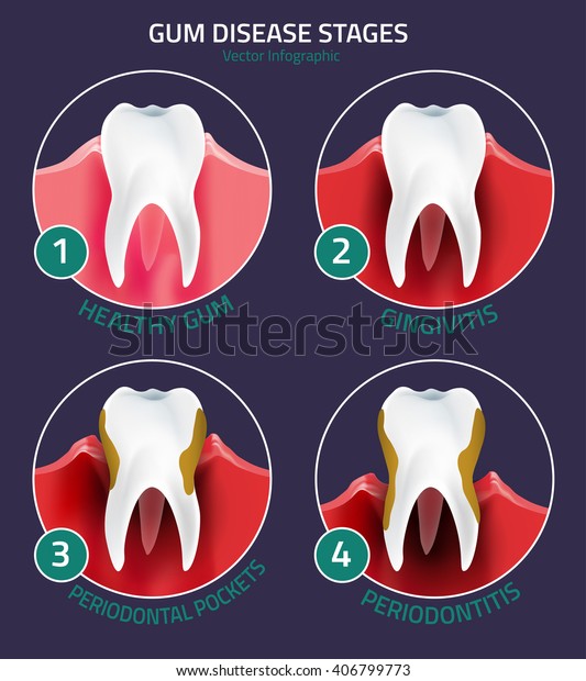 Teeth Vector Infographic Stock Vector (Royalty Free) 406799773