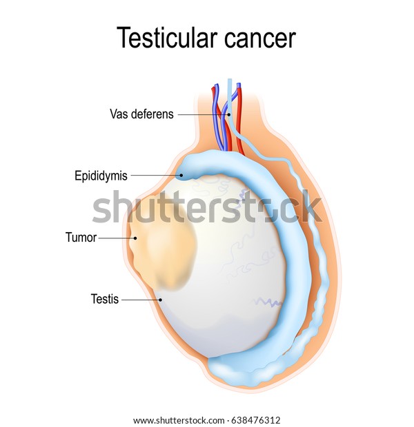 Testicular Cancer Tumor Develops Testicles Male: stockvector ...