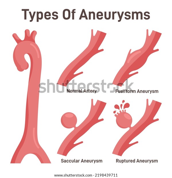 Stock vektor „Thoracoabdominal Aortic Aneurysms Types Healthy Aorta ...