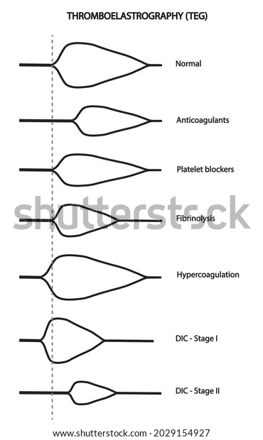 Thromboelastography Teg Blood Coagulation Analysis Types Stock Vector ...