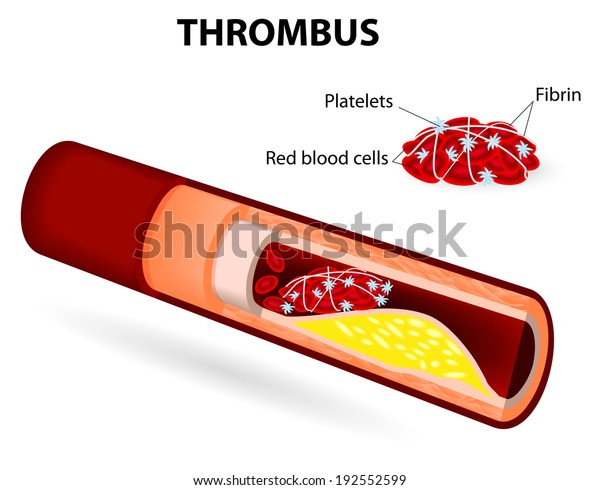 Thrombus Blood Clot Vector Diagram Illustration Stock Vector (Royalty ...