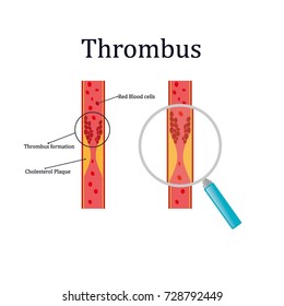 Thrombus Thrombosis Illustration Vector Design Thrombosis Stock Vector ...