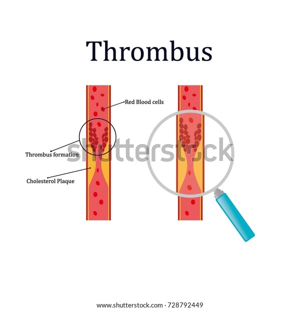 Thrombus Thrombosis Illustration Vector Design Thrombosis Stock Vector ...
