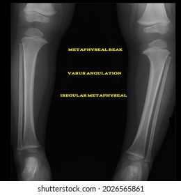 10 Tibia vara Images, Stock Photos & Vectors | Shutterstock