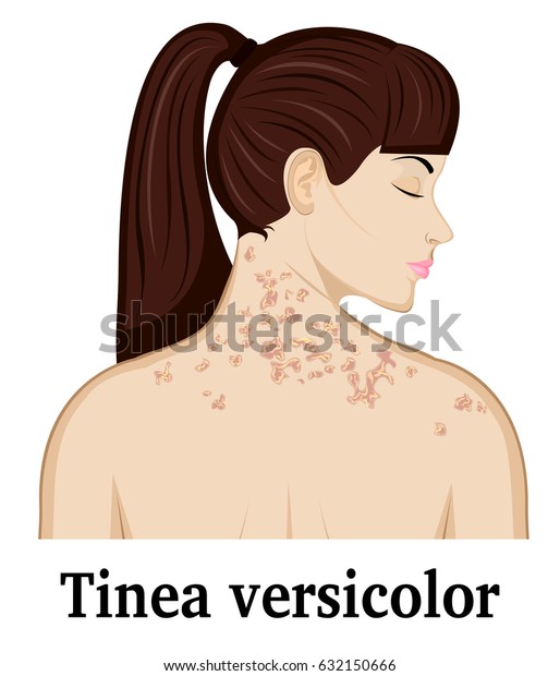 Tinea Versicolor On Neck Shoulders Young Stock Vector (Royalty Free ...