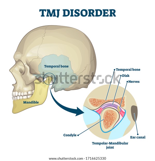 Tmj Disorder Vector Illustration Labeled Jaw Stock Vector (Royalty Free ...