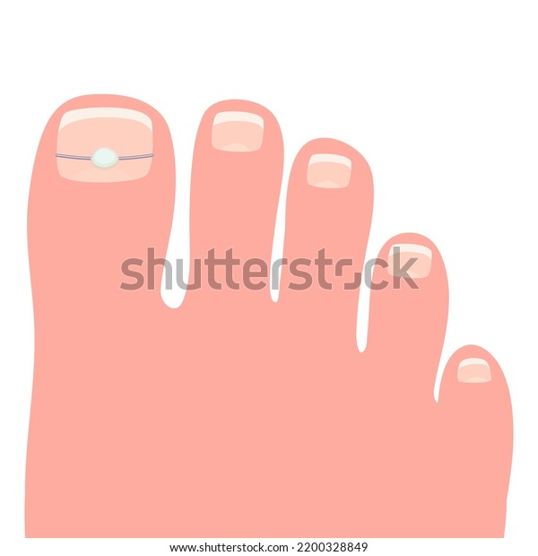 Toes On Right Foot Titanium Staple Stock Vector (Royalty Free ...