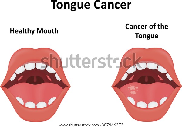 Tongue Cancer Stock Vector (Royalty Free) 307966373