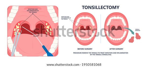 Tonsil Stones crypts viral virus gland strep throat sore enlarged lymph ...