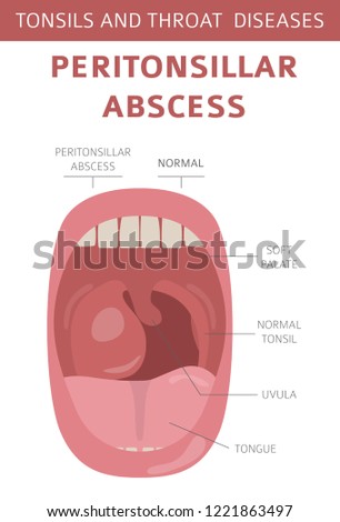 Tonsils Throat Diseases Peritonsillar Abscess Symptoms Stock Vector ...