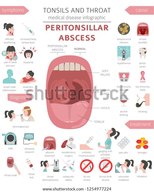 Tonsils Throat Diseases Peritonsillar Abscess Symptoms 库存矢量图（免版税 ...