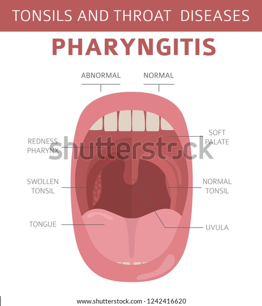 Tonsils Throat Diseases Pharyngitis Symptoms Treatment: stockvector ...