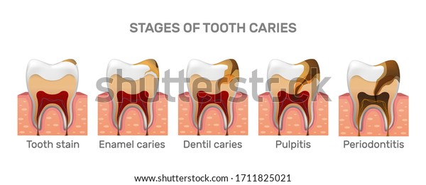 Tooth Caries Structure Full Placement Steps 库存矢量图（免版税）1711825021 ...