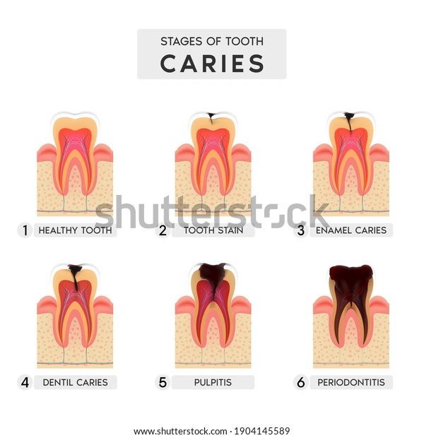 Tooth Caries Structure Progression Treatment Dental Stock Vector ...