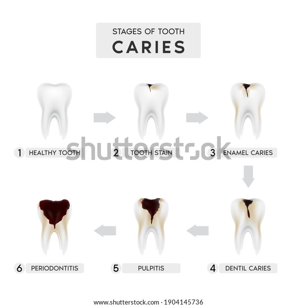 Tooth Caries Structure Progression Treatment Dental Stock Vector ...