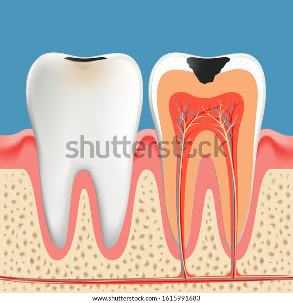 Tooth Decay Anatomy Poster Enamel Dentin: เวกเตอร์สต็อก (ปลอดค่า ...