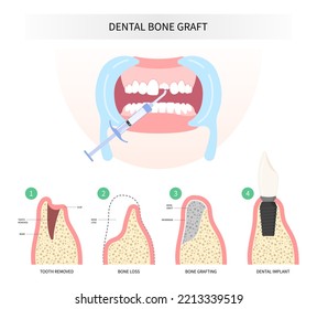 Tooth Decay Procedure Repair Breakdown Teeth Stock Vector (Royalty Free ...