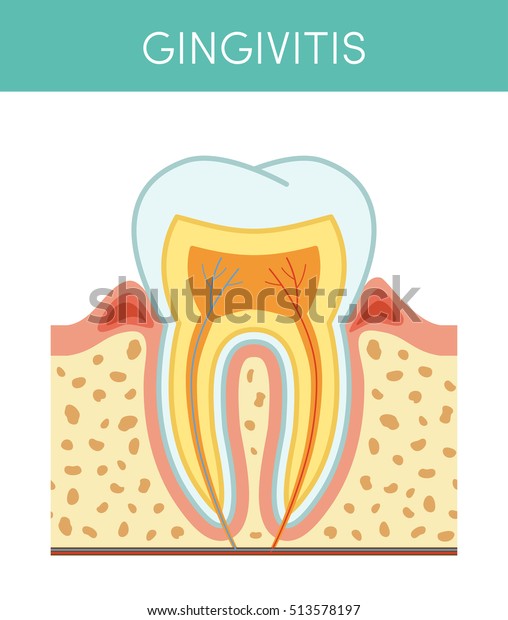 Tooth Diseases Gingivitis Vector Cartoon Illustration Stock Vector ...