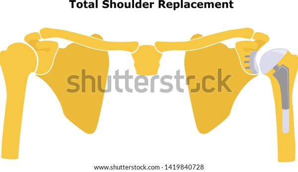 Total Shoulder Replacement Shoulder Joint Replacement Stock Vector ...